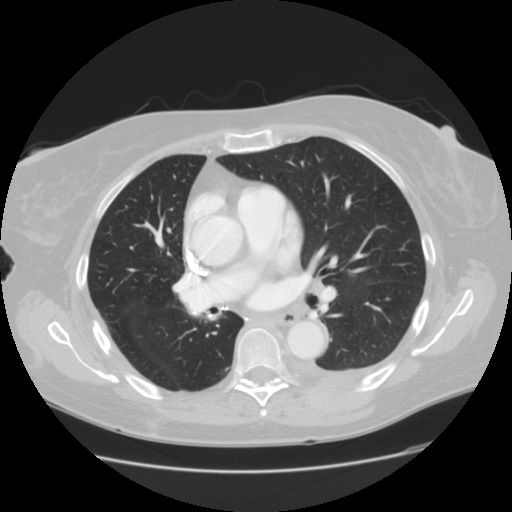 LungCancer Object Detection Dataset by Lung Nodules