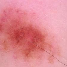 melanoma Classification Model by Shawn F