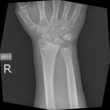 Bone Fractures Object Detection Dataset and Pre-Trained Model by l