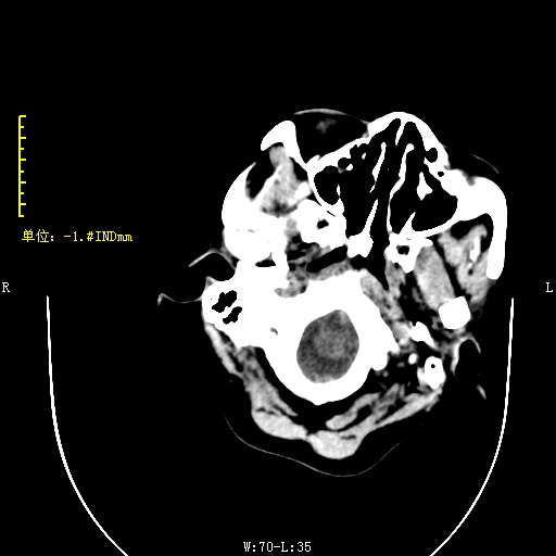 Ict Hemorrhage Segmentation Semantic Segmentation Model By Brainsegmentation