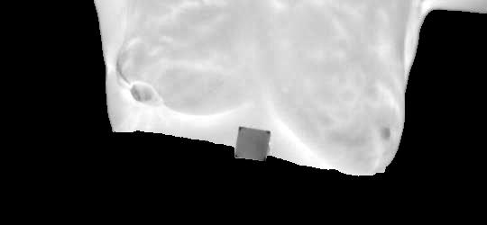 Cancer de pecho Object Detection Dataset by Cancer de Pecho