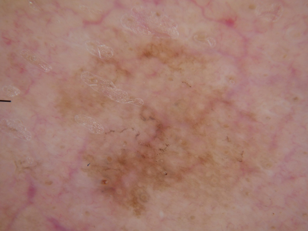 skin cancer Object Detection Dataset and Pre-Trained Model by ...