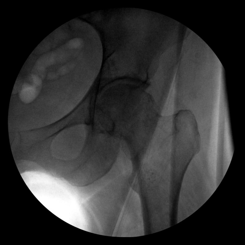 Hip Instance Segmentation Dataset by HipXrays