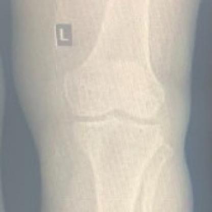 1st knee's segmentation mode Instance Segmentation Dataset by HipXrays