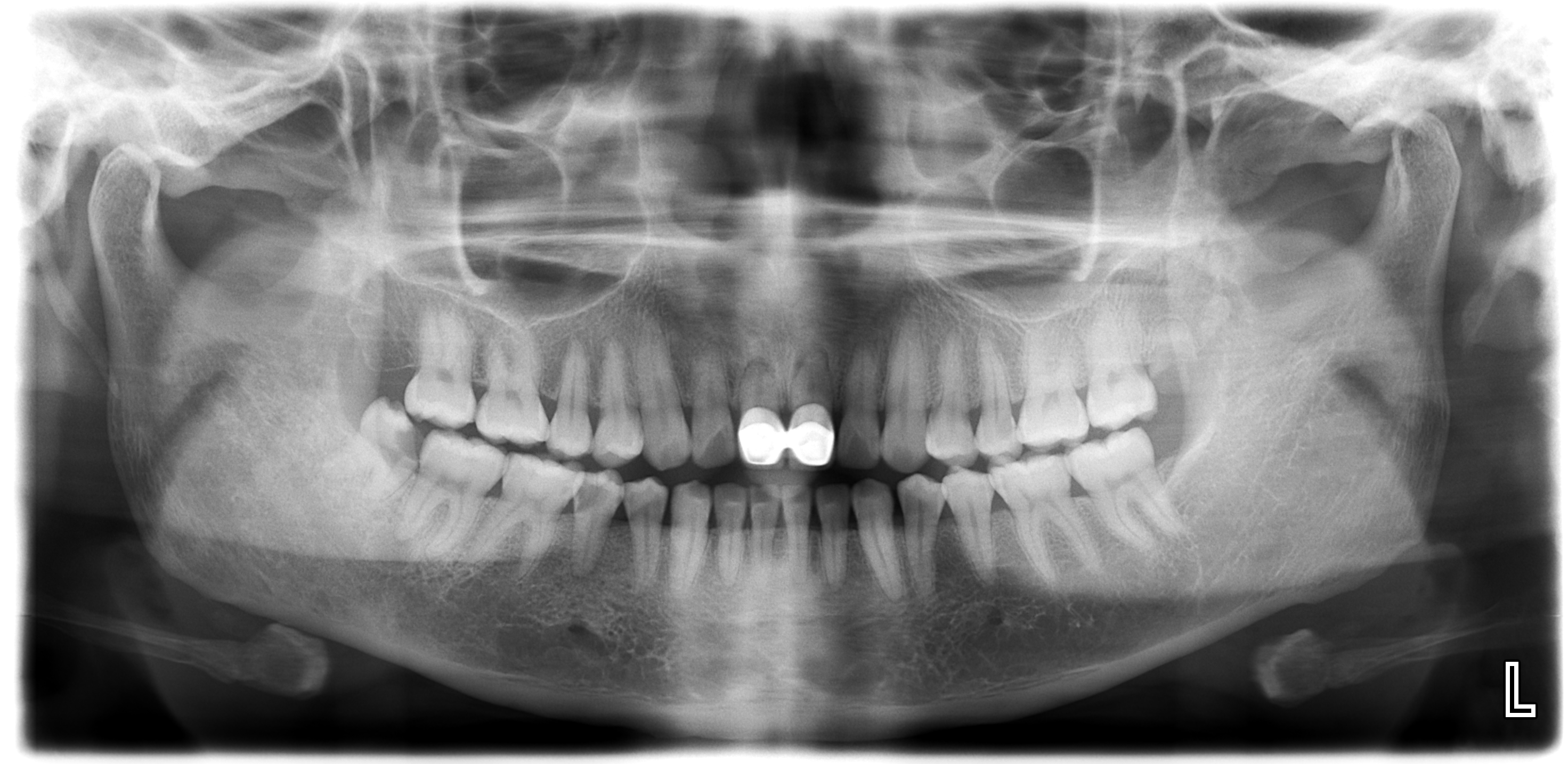 Wisdom Teeth Detection Object Detection Dataset And Pre Trained Model