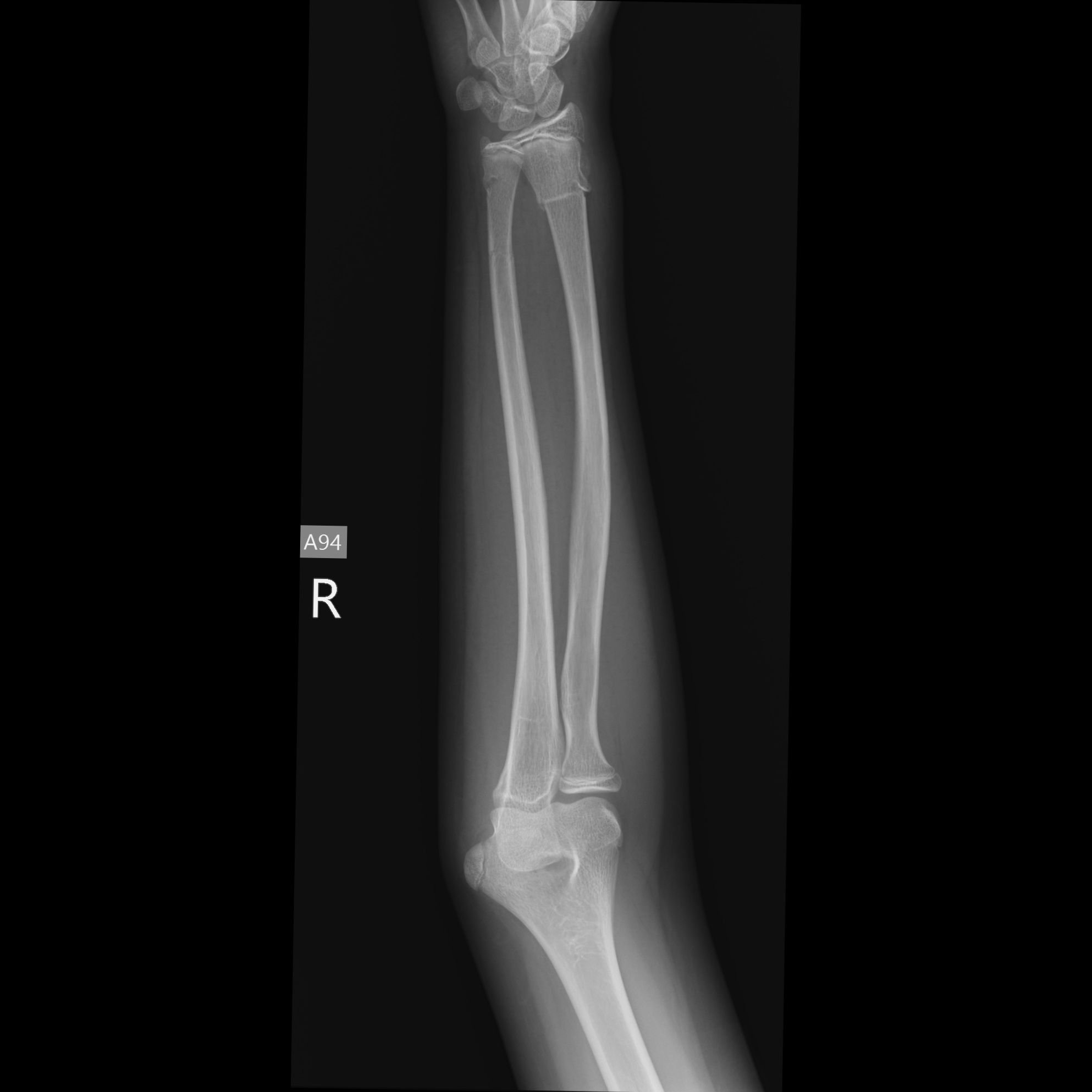 Bone Fracture Object Detection Dataset by My Lab