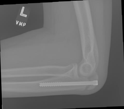 Bone Fracture Detection Object Detection Model by My Lab