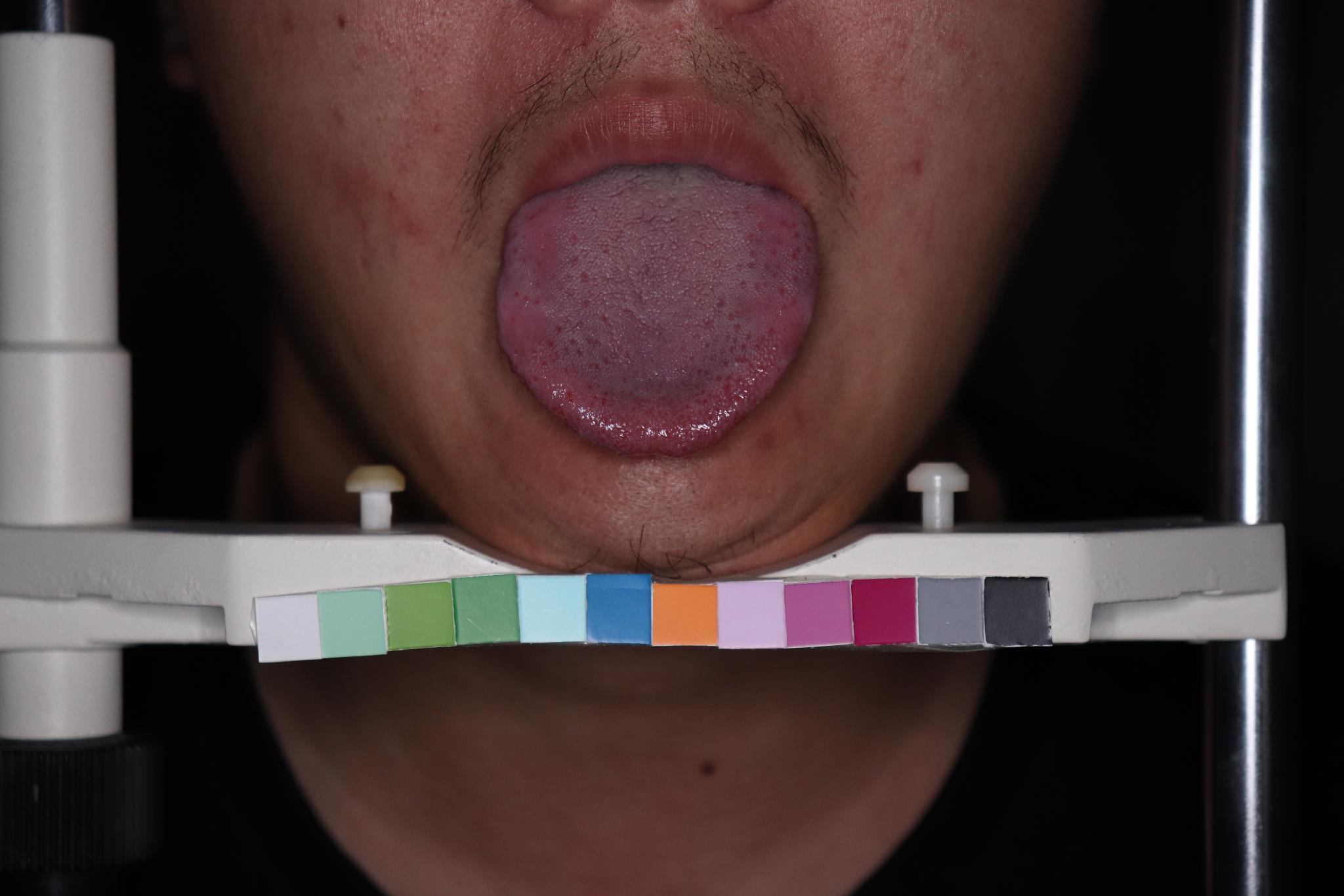 b12 deficiency detection Object Detection Model by Iris Project