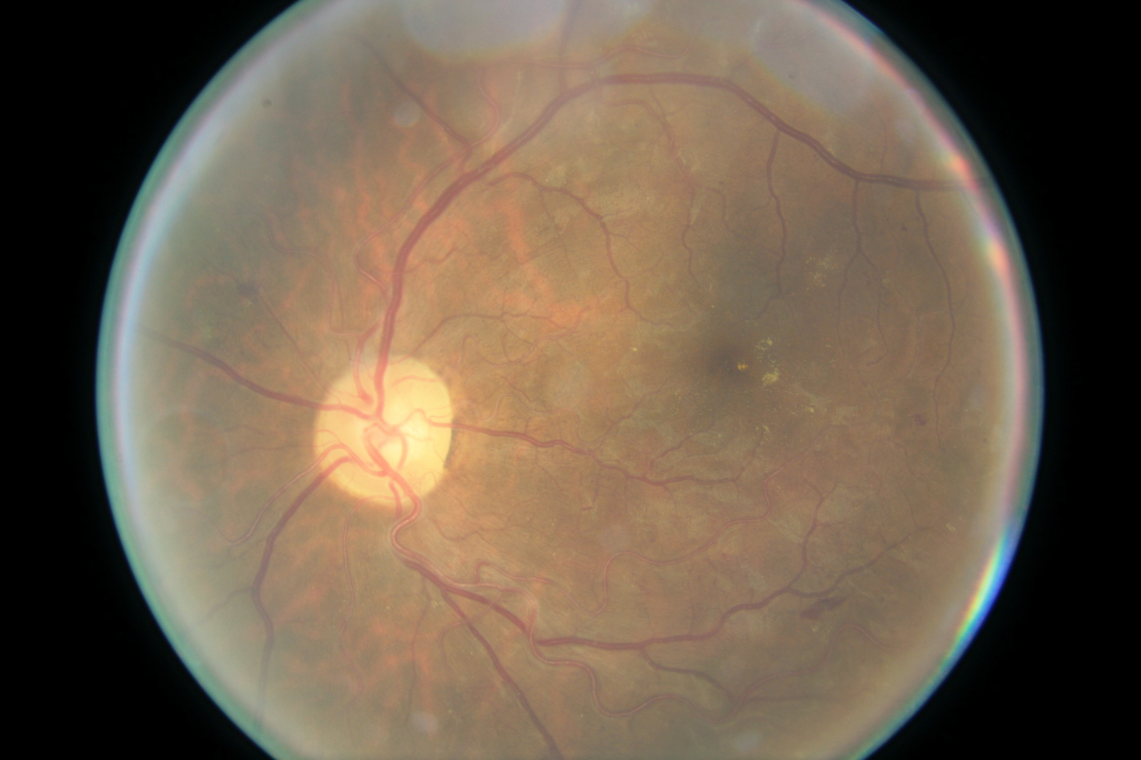 Single Label Classification of DR Classification Dataset and Pre ...