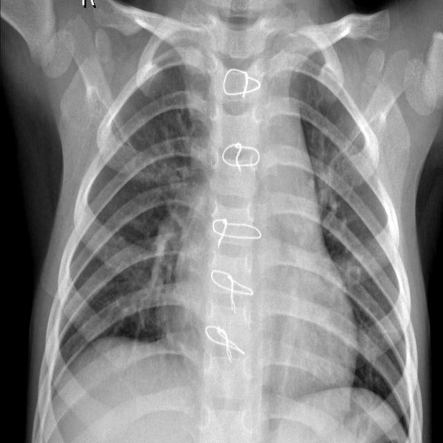 x-ray_project Classification Dataset (v2, 2023-11-21 3:10pm) by buksu