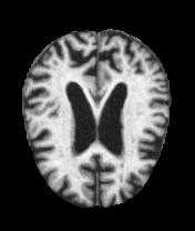 Alzheimer classification Classification Dataset by Nour
