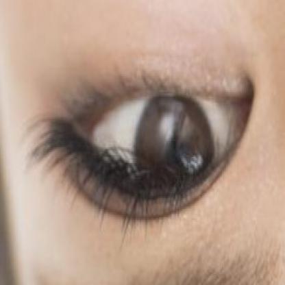 redness eyes Classification Dataset by name