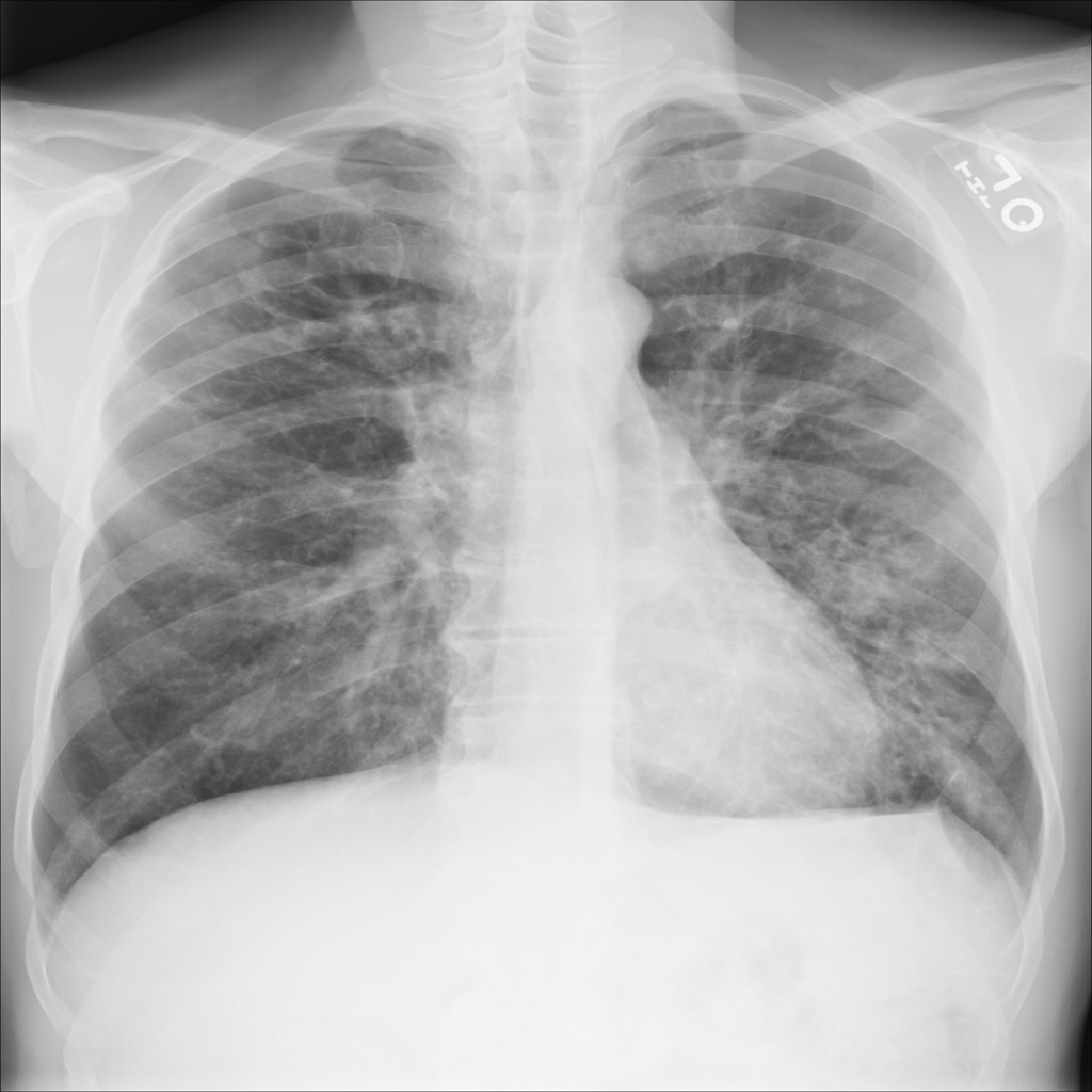 Features Fibrosis Instance Segmentation Dataset By Rayproject