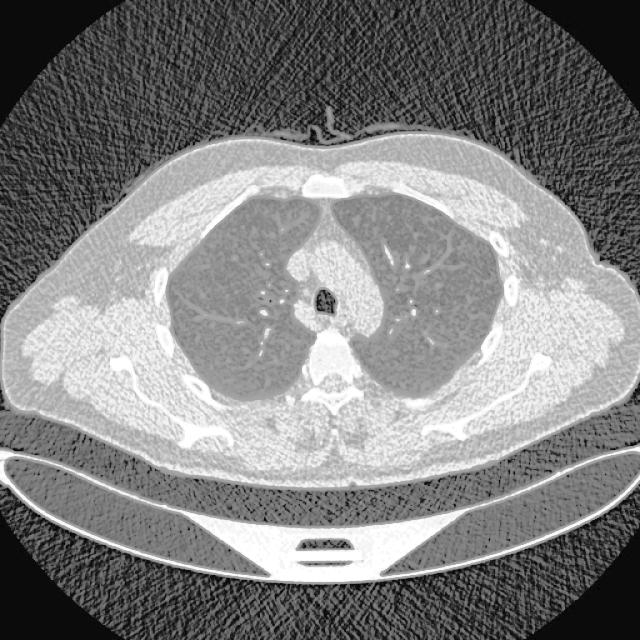 LUNG CANCER DATASETS Object Detection Dataset (v2, 2025-05-15 7:02pm ...