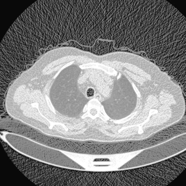 Lung Cancer Dataset Object Detection Dataset And Pre Trained Model By