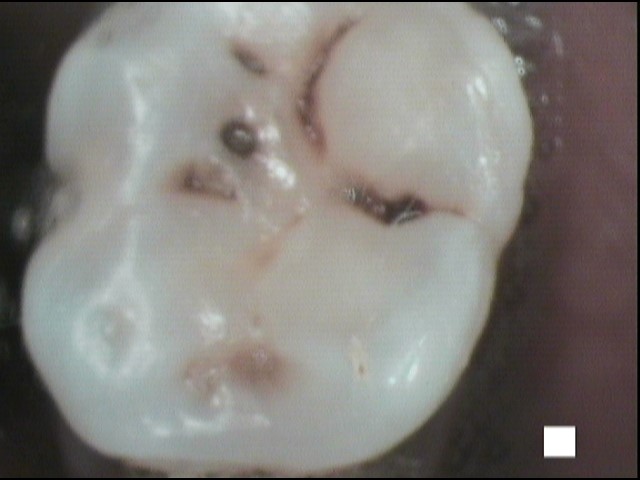 Dental_Caries_AIIMS Object Detection Dataset by SummerProjects