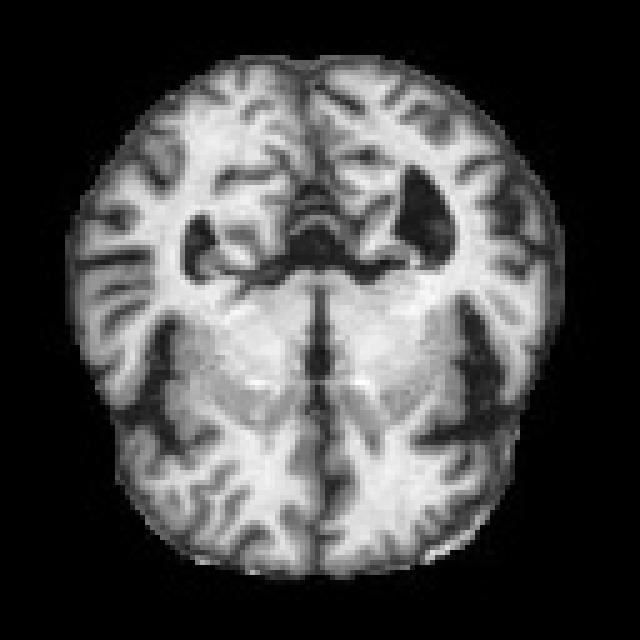 MRI Classification Model by alzheimers
