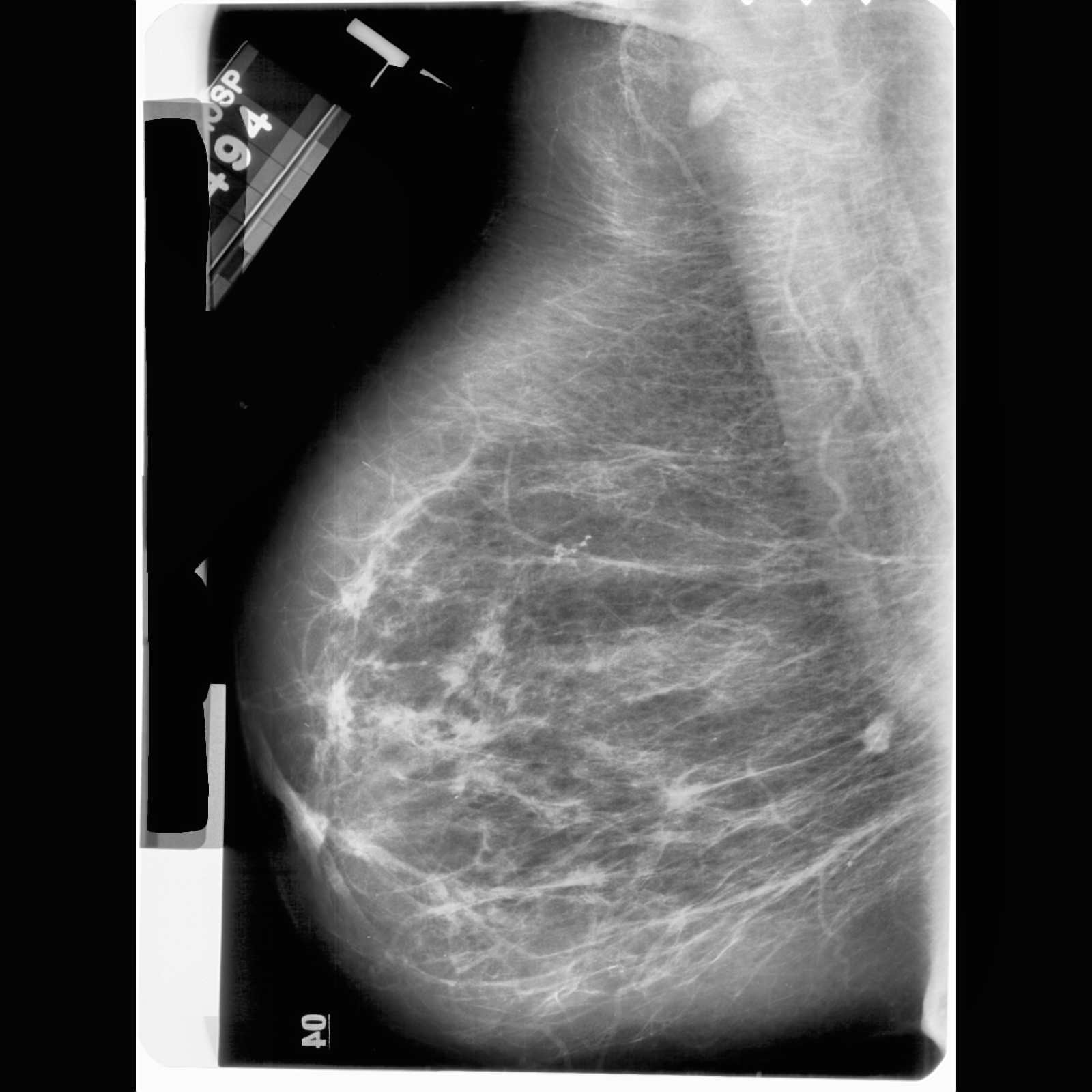 Meme Kanseri Tespiti Object Detection Dataset And Pre Trained Model By Mamografi