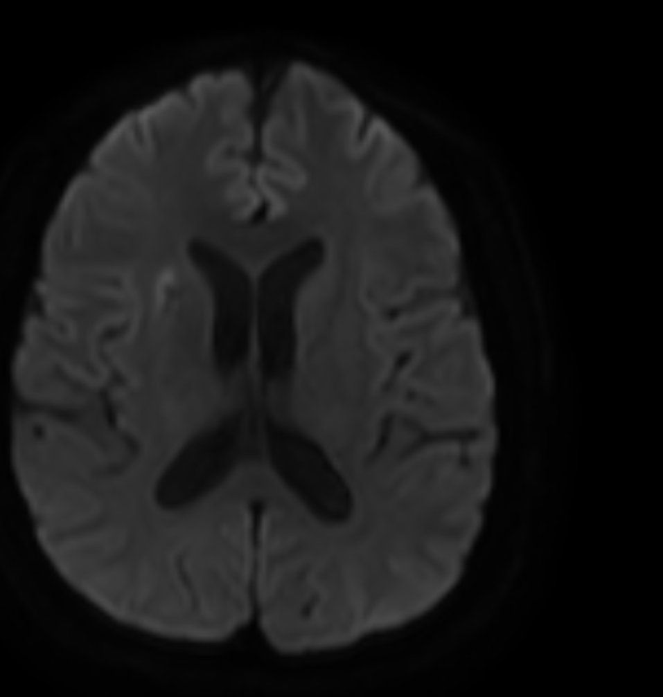 DWI BLEED DETECTION Object Detection Dataset and Pre-Trained Model by DWI BLEED DETECTION