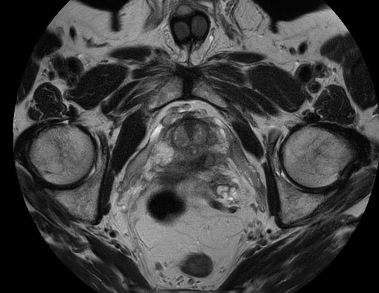 PROJECT CHOO T2 Object Detection Dataset by DWI BLEED DETECTION