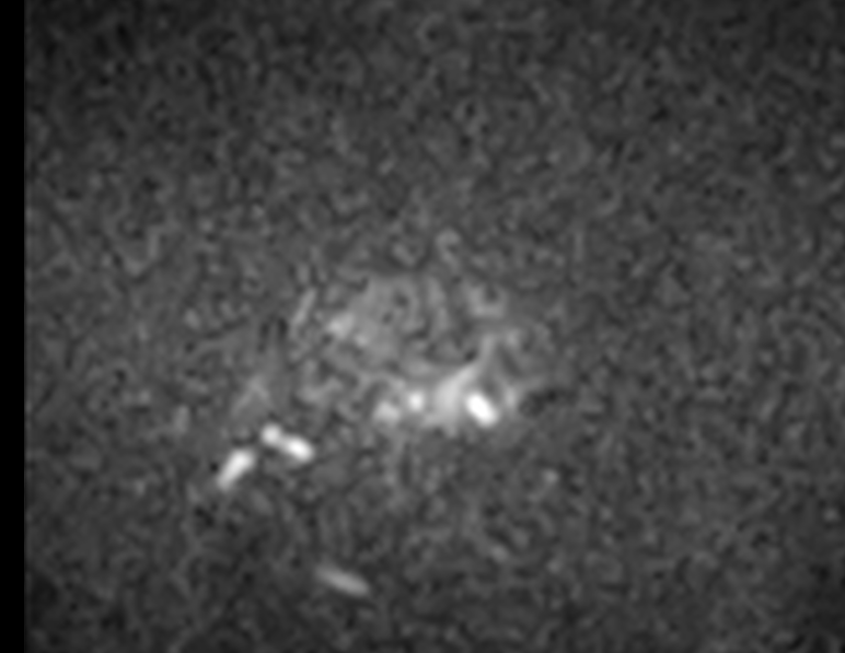 PROJECT AIMI - DWI Object Detection Dataset by DWI BLEED DETECTION