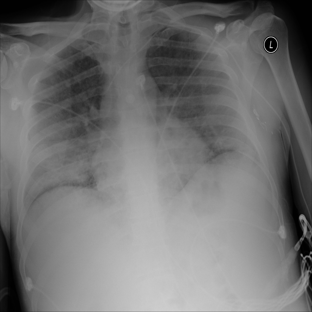 lung Object Detection Dataset by Barcode