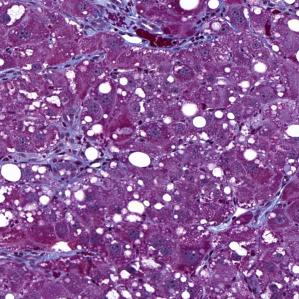 liver disease Object Detection Dataset by work