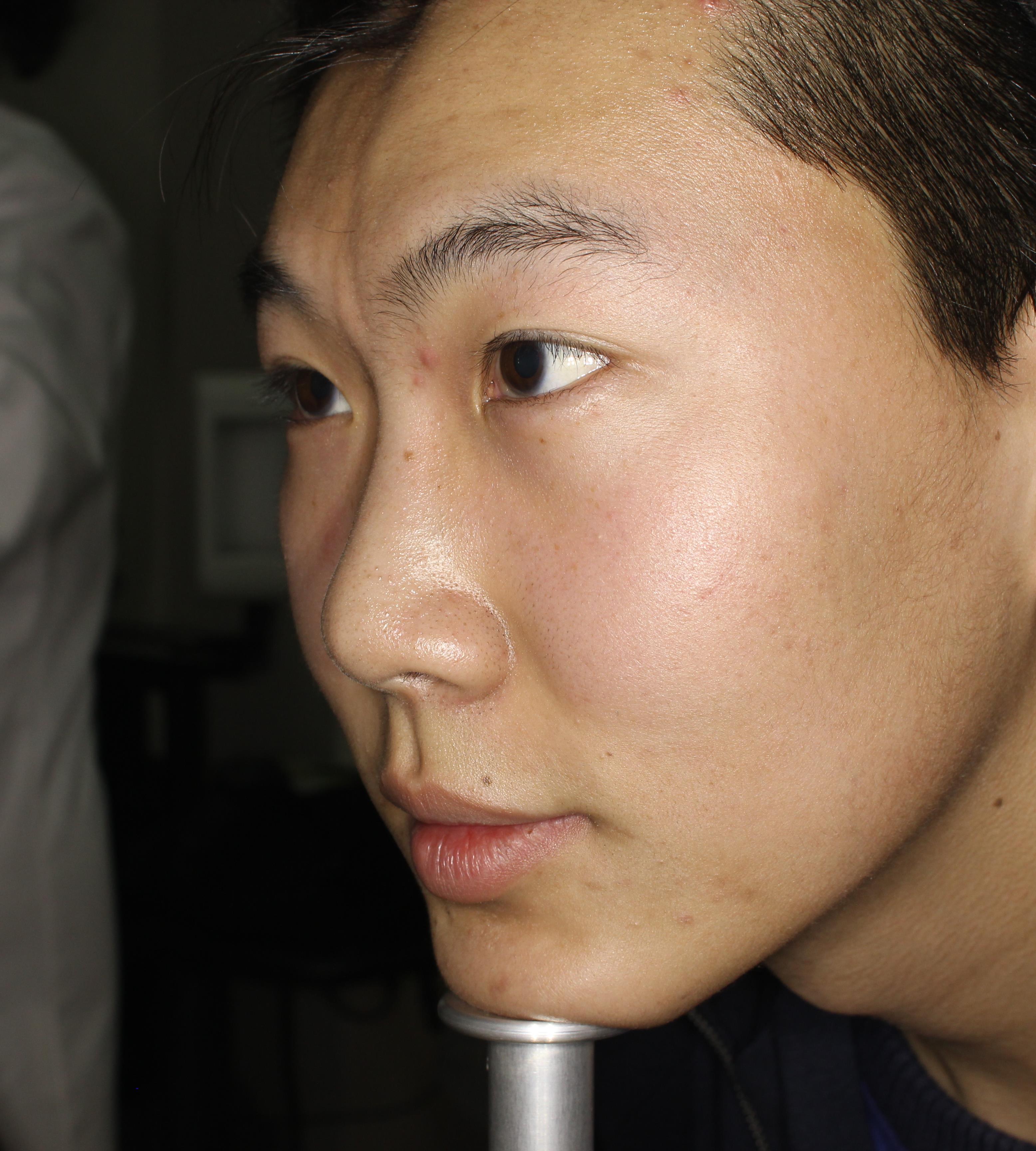 acne04_notest_fore Object Detection Dataset by Umer