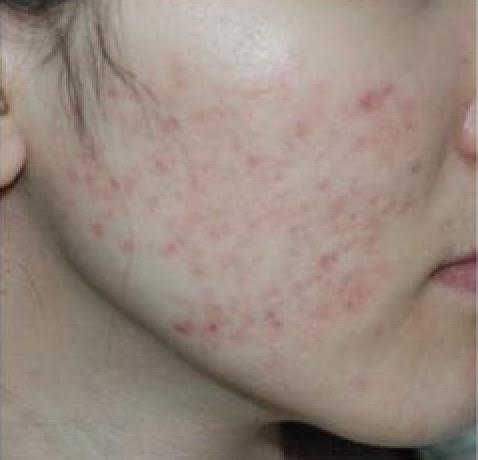 acne04 Object Detection Model by Umer