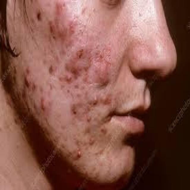 Acne Datasets Object Detection Model By Acne Dataset