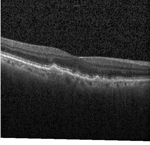 Eye Disease Detection Object Detection Dataset By Ws