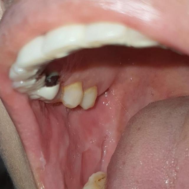 Caries Temprana Object Detection Dataset And Pre Trained Model By Adriana Candia