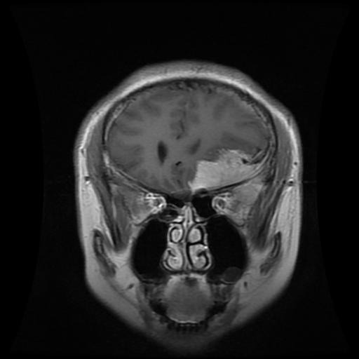 Mri Classification Dataset By Yolowork