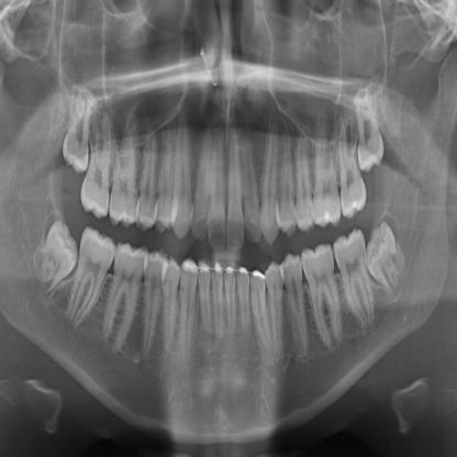 Top Teeth_u Datasets and Models | Roboflow Universe