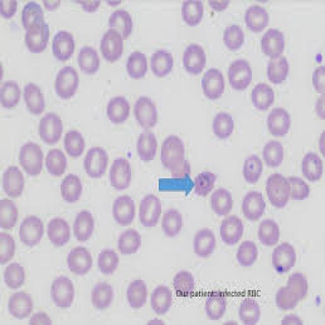 Malaria Detection12 Roboflow Universe