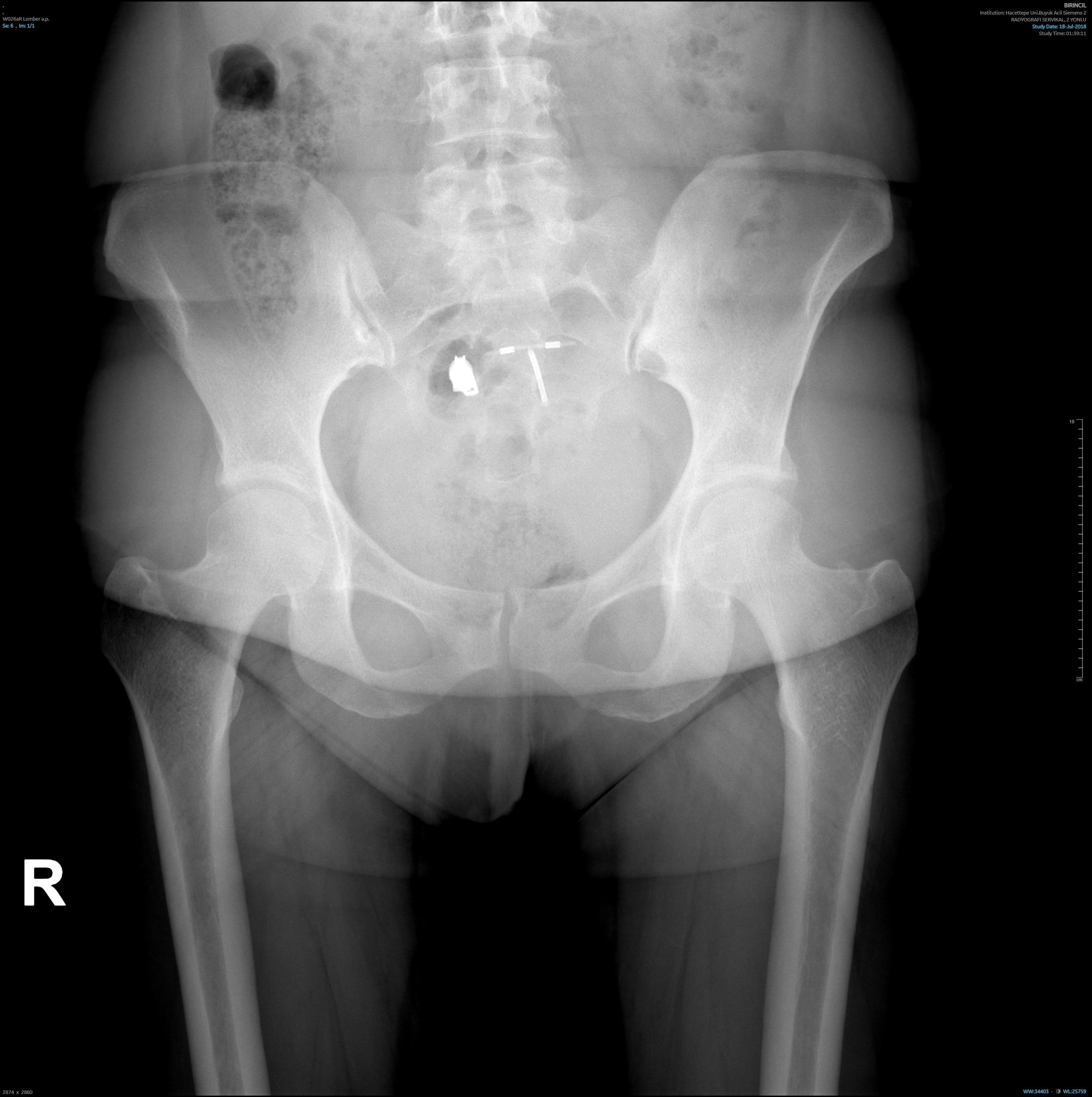 Pelvis AP X-ray Instance Segmentation Dataset by Linas WS