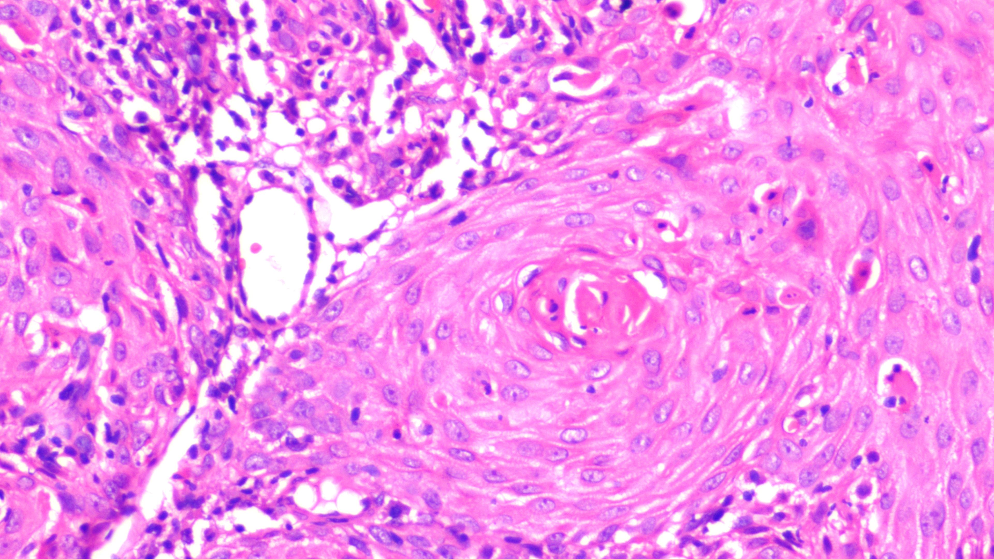 Keratin Pearls20x Combine Object Detection Dataset By Oral Cancer New