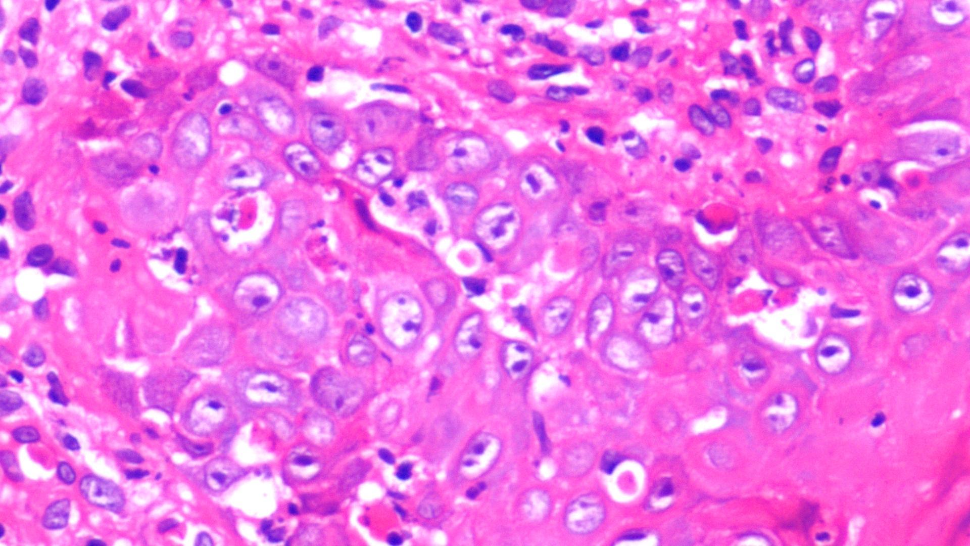 Multiple_nucleoli Object Detection Dataset by Oral Cancer new