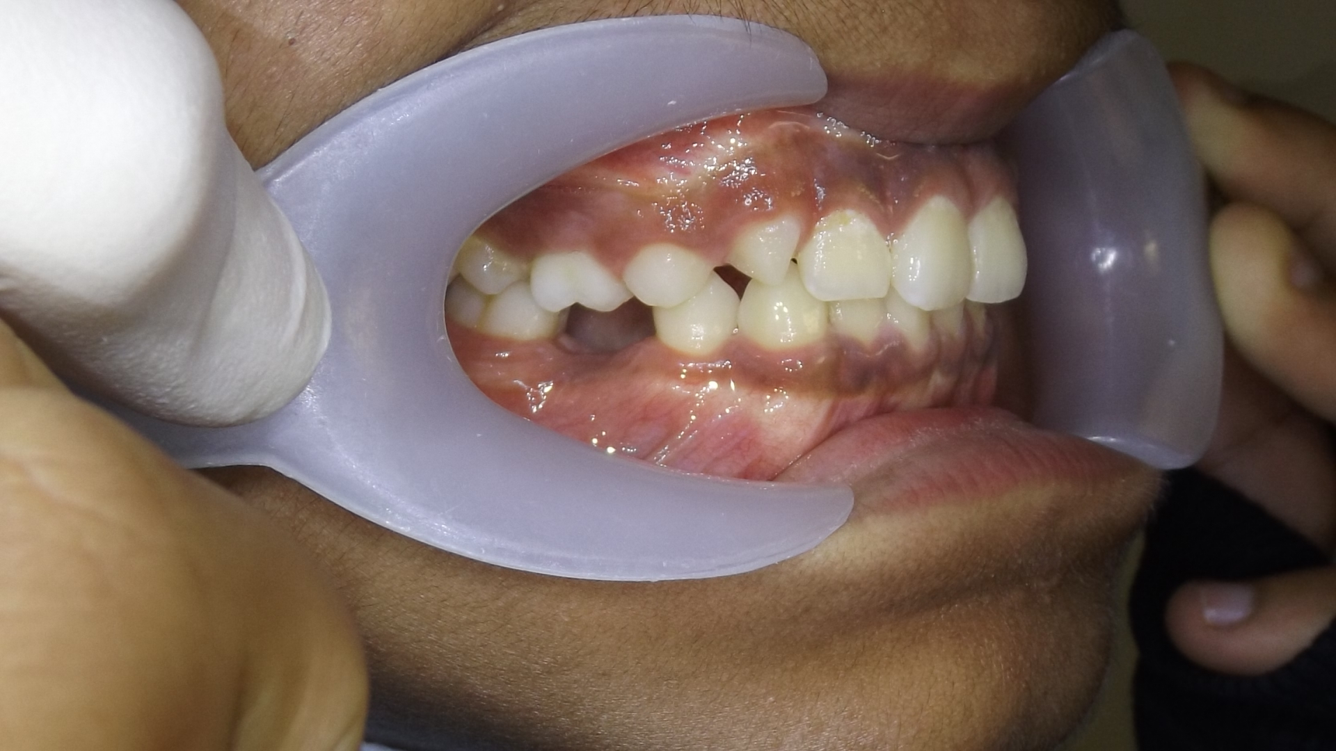 Teeth Occlusion Object Detection Dataset and Pre-Trained Model by teeth