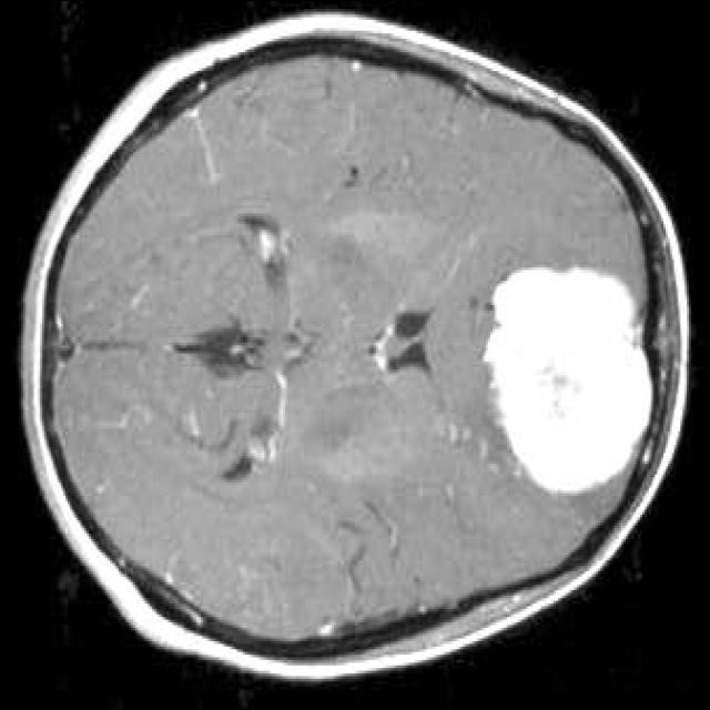 BRAIN-TUMOR Instance Segmentation Model (v1, 2025-01-09 11:54am) by ...