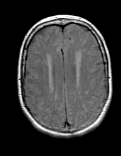 MRI BASED BRAIN STROKE DETECTION Object Detection Dataset by uk
