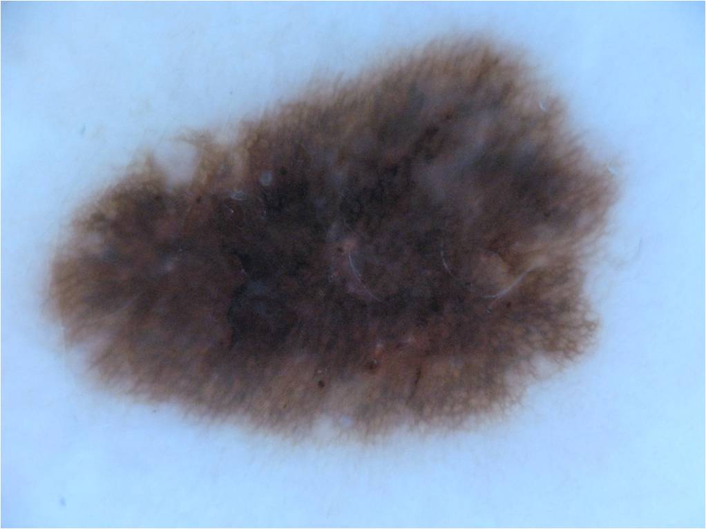 Skin Cancer Isic 2019 Object Detection Dataset And Pre Trained Model