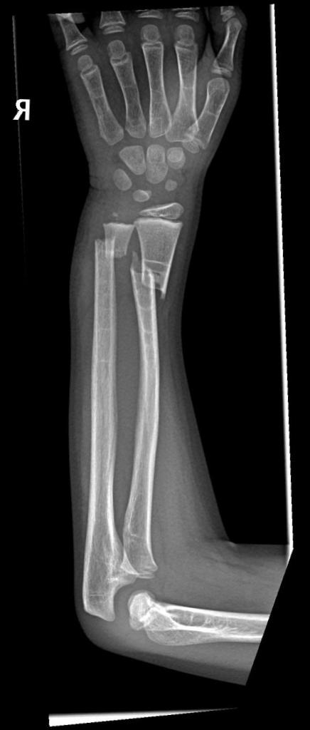 How to Use the Bone Fracture Identification_V2 Object Detection API