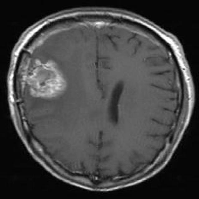 Brain Tumor IS Instance Segmentation Dataset and Pre-Trained Model by cell