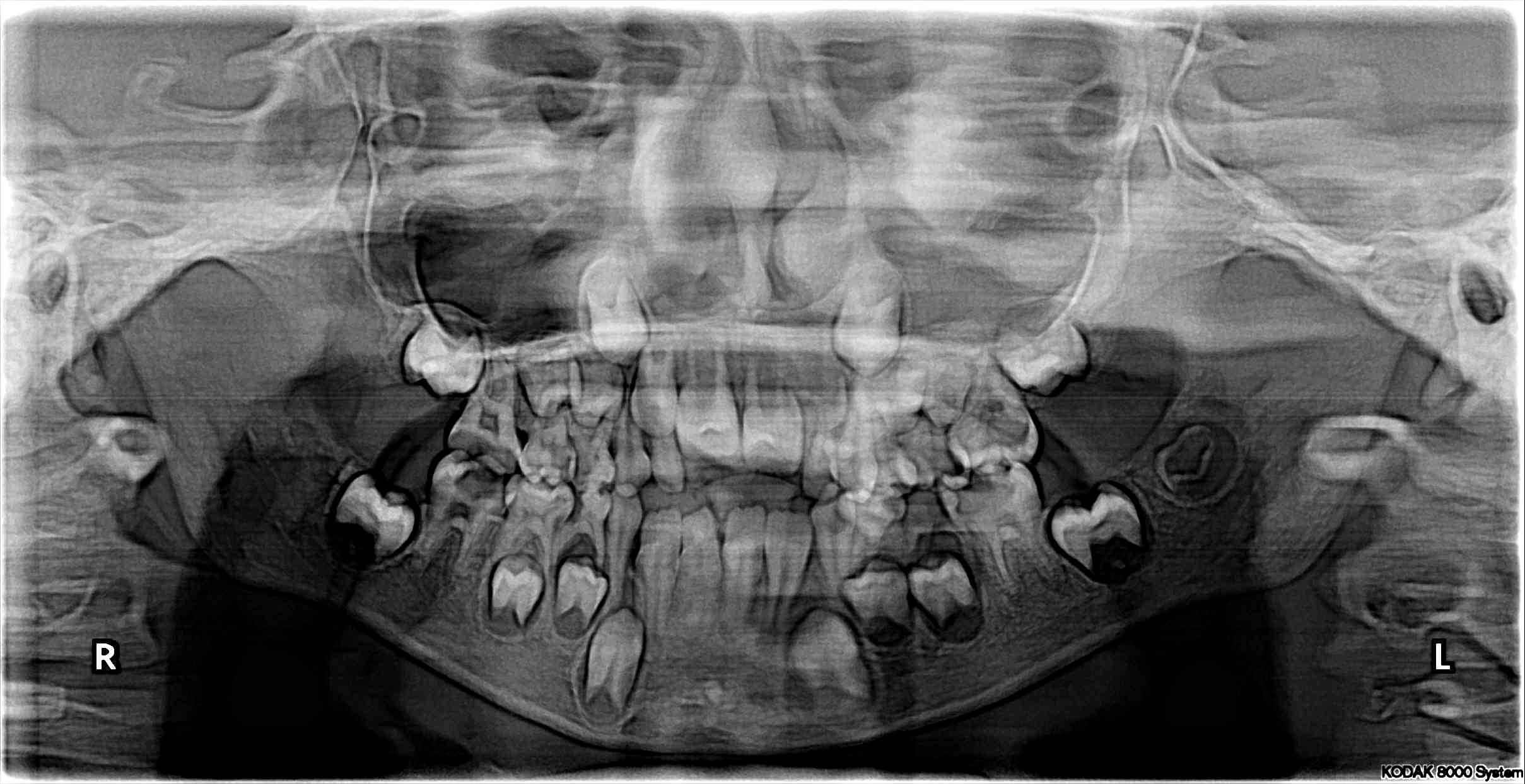 deep learning with dental OPGs - Roboflow Universe