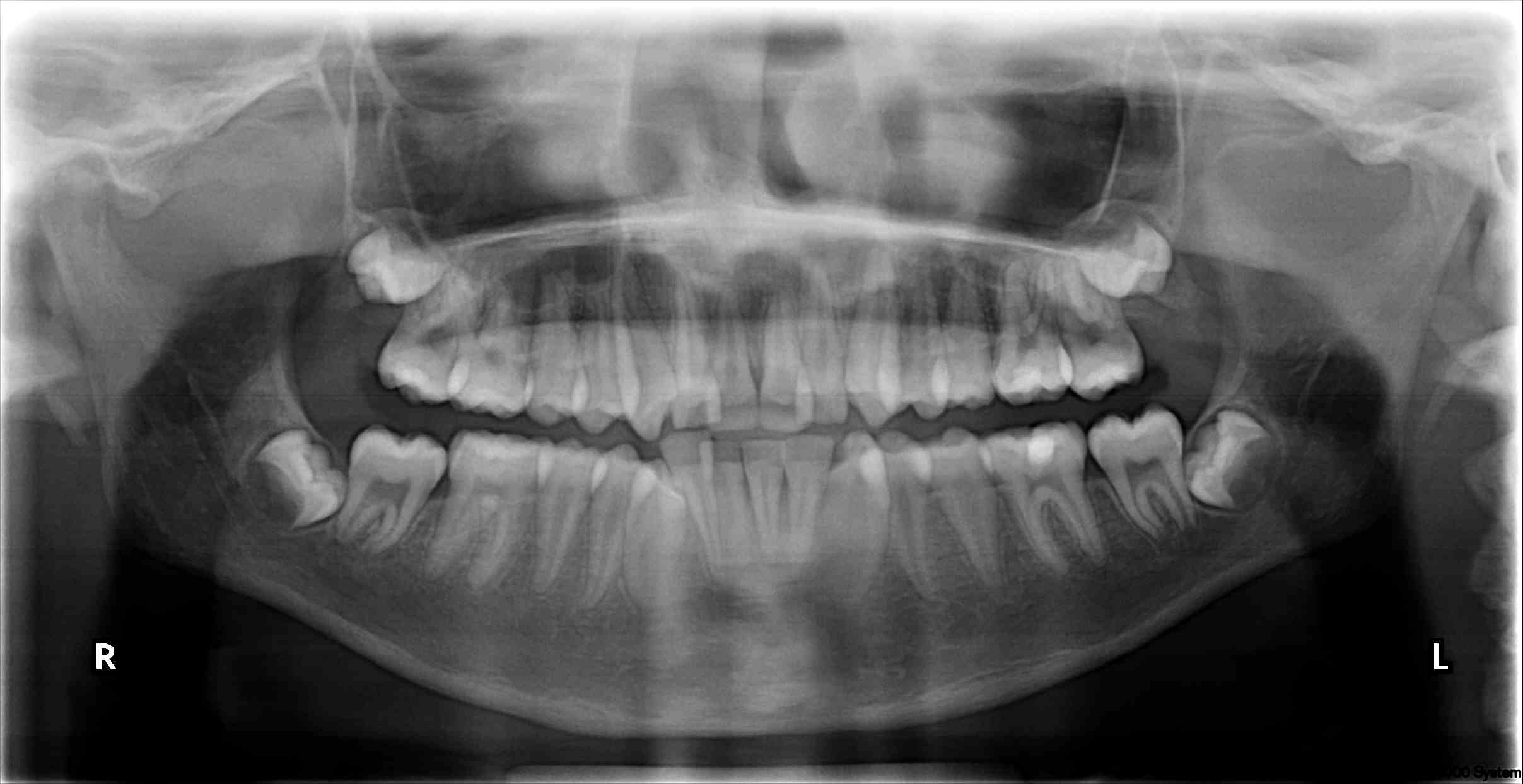 PGI_obj_det Object Detection Dataset by deep learning with dental OPGs