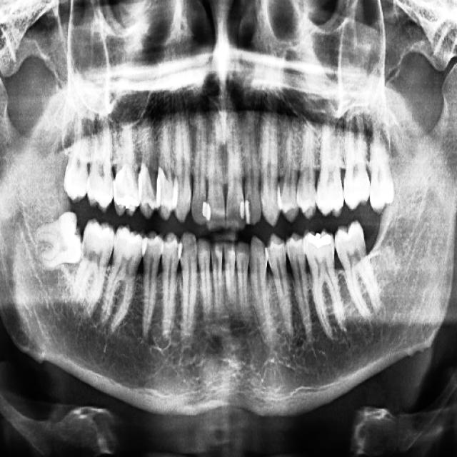 Dentists Xrays Object Detection Dataset And Pre Trained Model By Zaks Lab