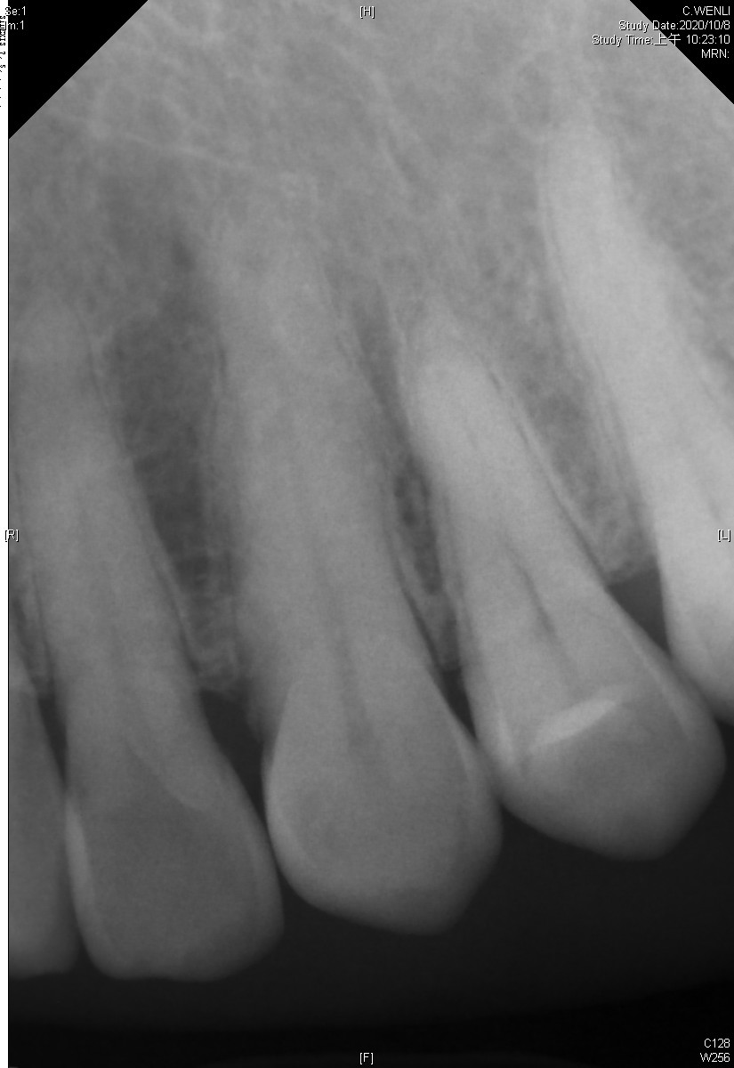 Test 1112 01 Apical Lesion Single Object Detection Dataset By Project Tx2ls