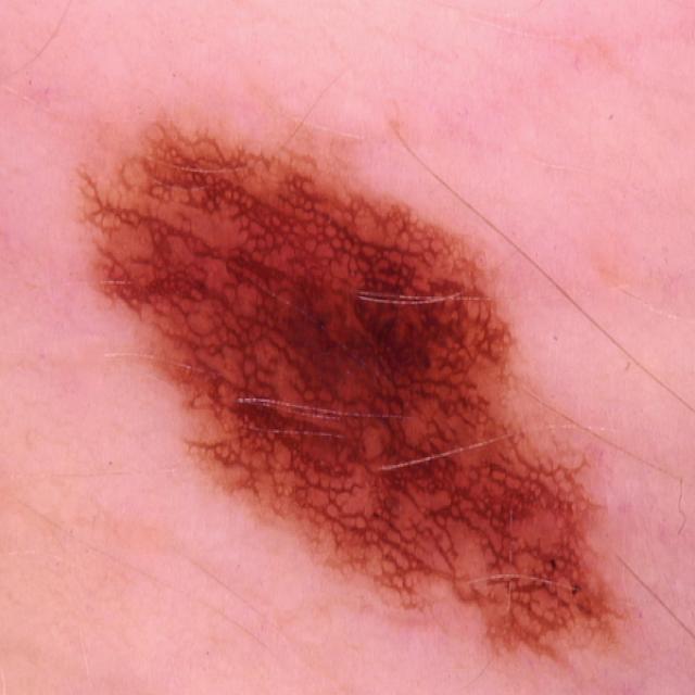 skin cancer Object Detection Dataset by National Taipei university