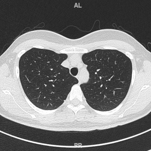 Lung Object Detection Dataset and Pre-Trained Model by Chris